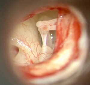 Ossicular Chain Reconstruction | Dr. Neil Sperling NYC