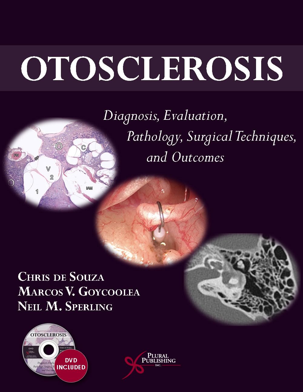 Otosclerosis Doctor NYC | Expert Dr. Neil Sperling
